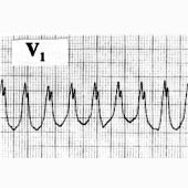Quia - Electrocardiography