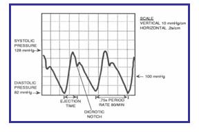 Quia - Class Page - Arterial Line Removal