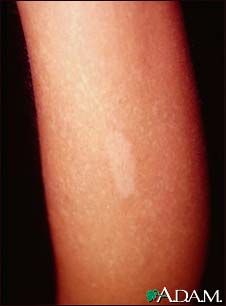 Quia - Primary lesions