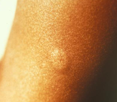 Quia - Primary lesions