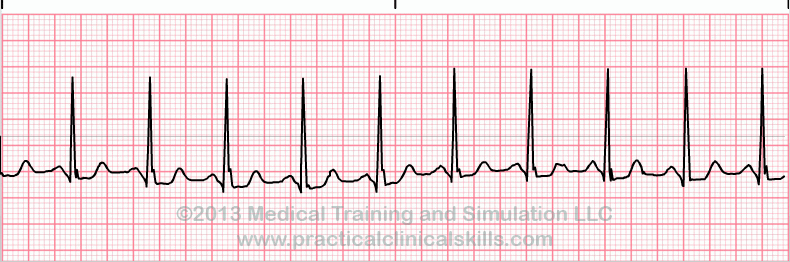 Quia - Cardiac Dysrhythmias