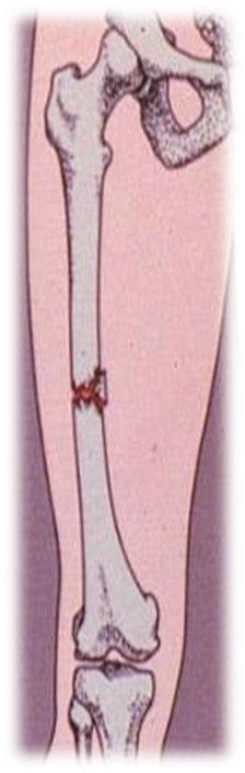 Quia - Yazvac - Fractures