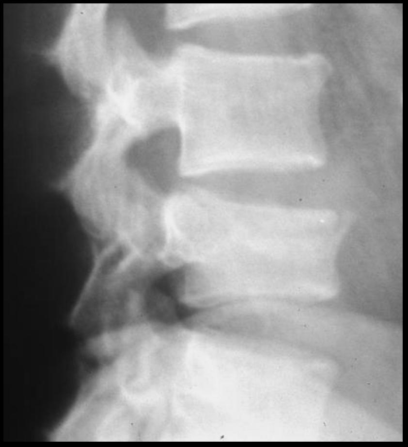 Quia - Yazvac - Fractures