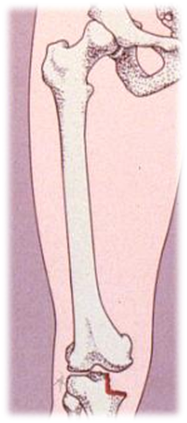 Quia - Yazvac - Fractures